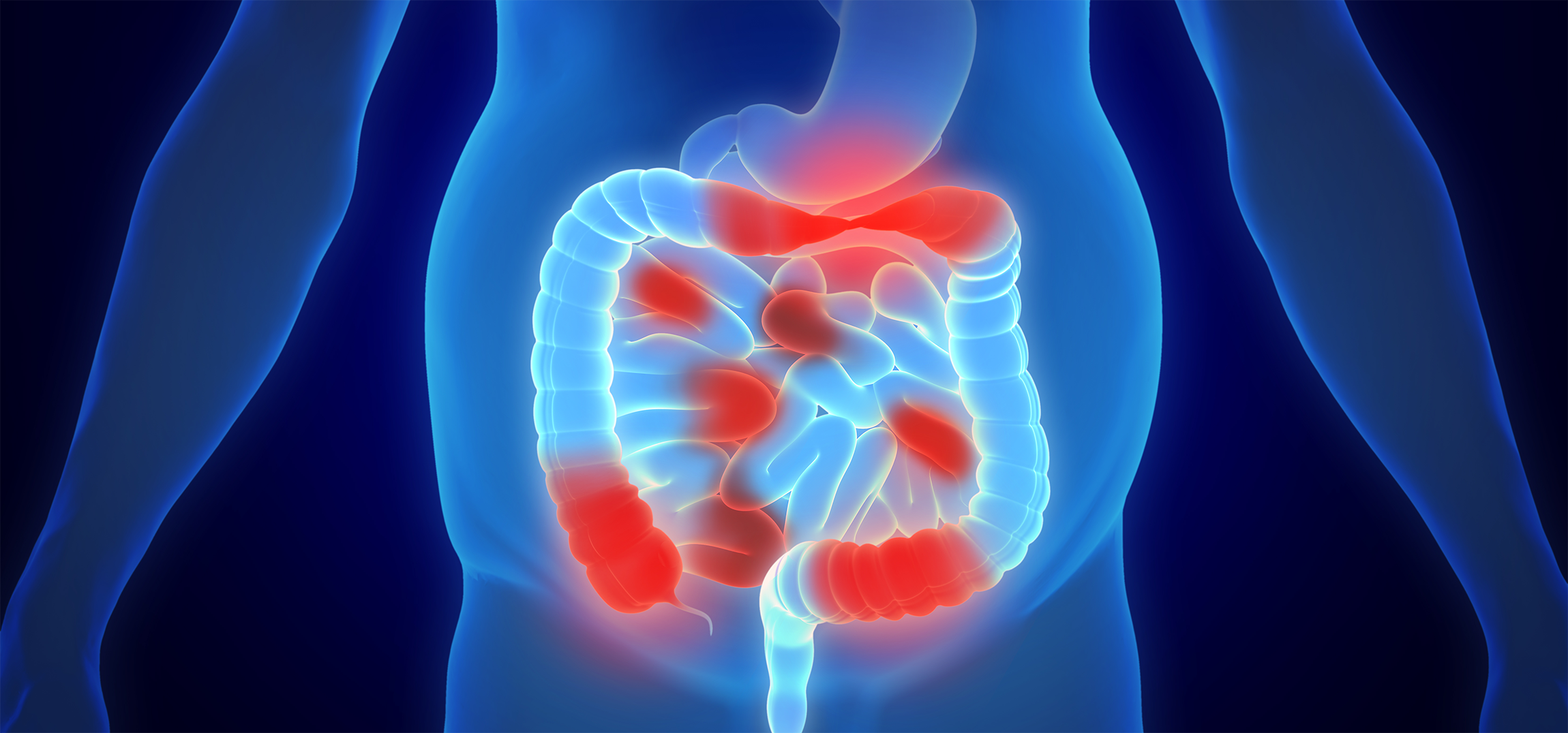 Mastering Inflammatory Bowel Disease The SIBO Doctor Mastering Inflammatory Bowel Disease The SIBO Doctor